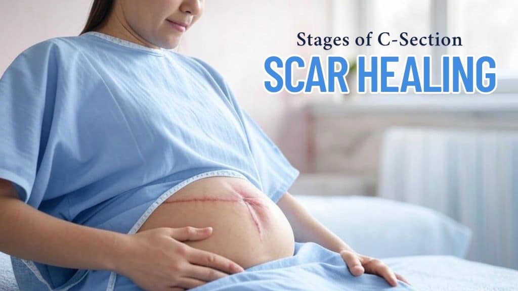 From Pain to Recovery: C-Section Scar Healing Stages - Mothers Always Right