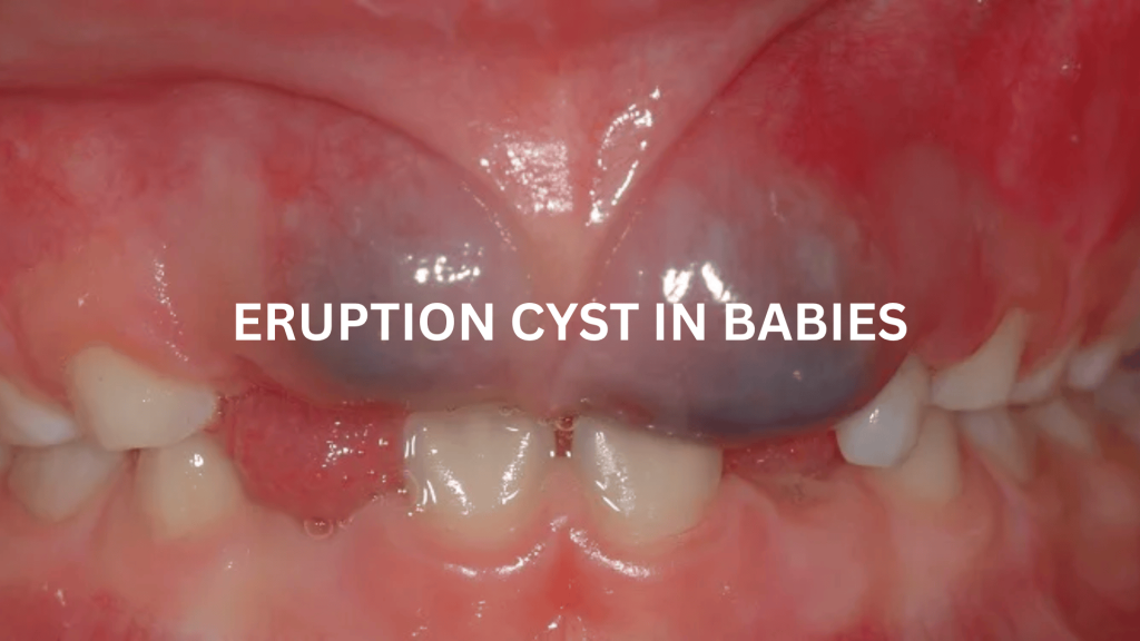 Eruption Cyst in Babies: Causes, Symptoms, & Treatment - Mothers Always ...
