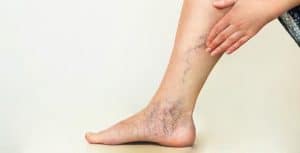 Clear Spider Veins Fast with Safe, Expert Treatments - Mothers Always Right